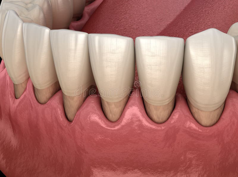 Gum Recession Process. Medically Accurate 3D Illustration Stock ...