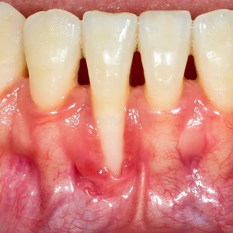 Gum Recession and Tooth Discoloration Stock Photo - Image of healthy ...