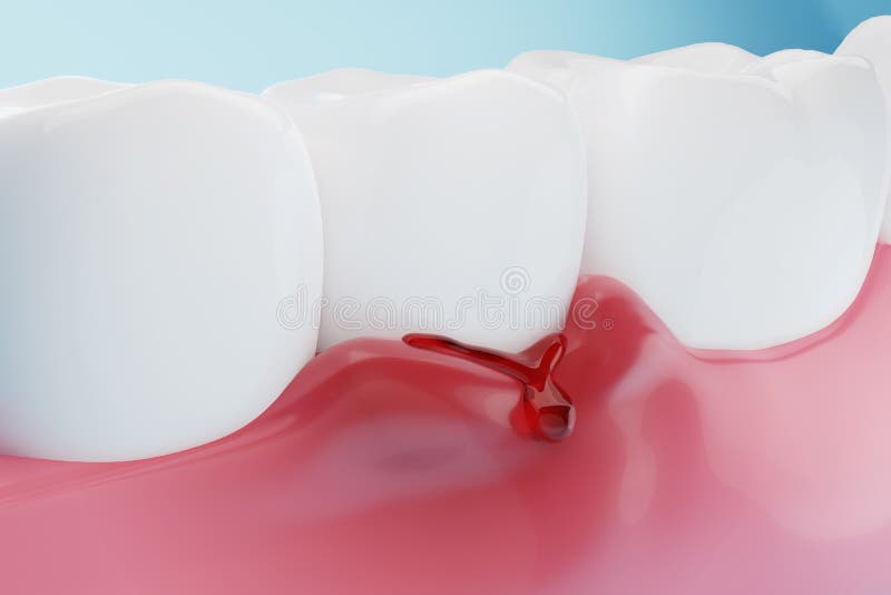 Gums Disease with Bleeding 3D Rendering. Stock Illustration ...
