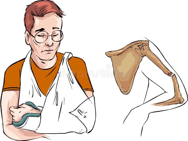 Guy with an arm fracture stock vector. Illustration of hand - 53691682