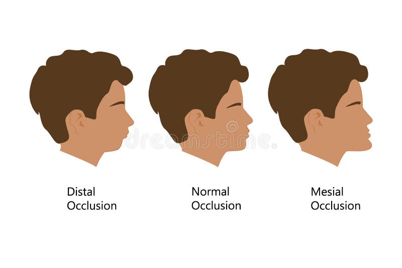 Guy with Distal, Normal, and Mesial Bite Profile, Vector Illustration ...