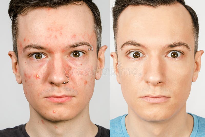 Two Guys before-after: Left Guy with Acne, Red Spots, Problem Skin ...