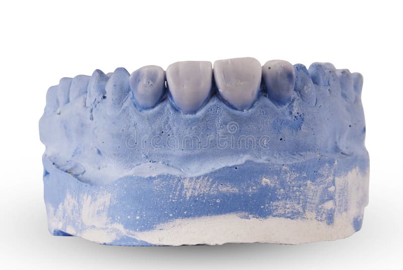 Gypsum model of jaw stock image. Image of molar, prosthetic - 127679759