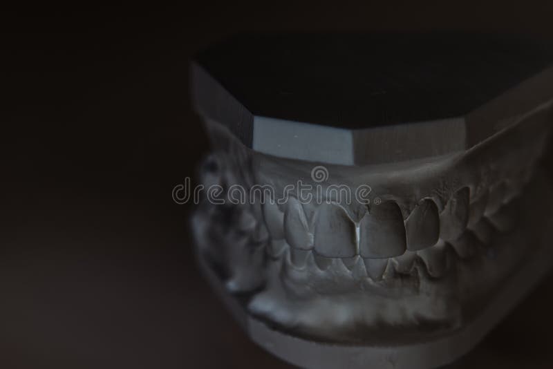 Gypsum Model of Human Jaw on a White Background. Stock Photo - Image of ...