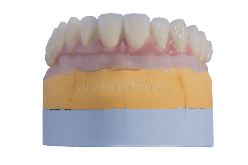 Gypsum Model with Implants and Ceramic Teeth Stock Image - Image of ...