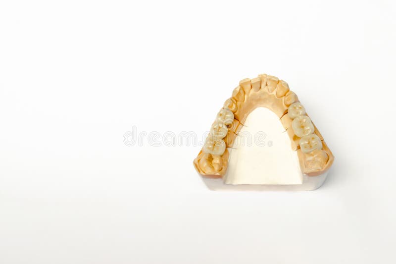 Gypsum Model of the Teeth of the Lower Jaw with Ceramic Teeth. False ...
