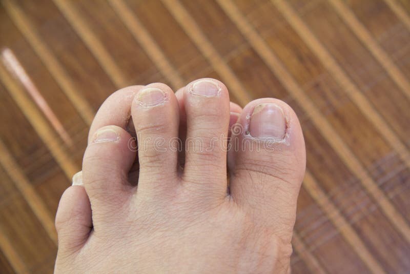 Hässliche Füße stockbild. Bild von namen, menschlich - 94942777