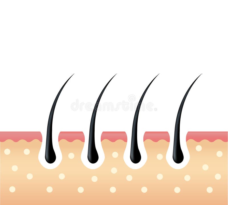 Schuppen Auf Haar, Haarkopfhaut Pilz Auf Der Kopfhaut Ursache Des ...