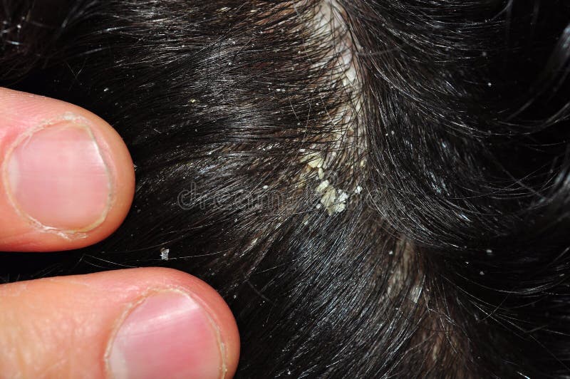 Schuppen Im Haar Flockige Kopfhaut Seborrhea Stockfoto - Bild von pilz ...