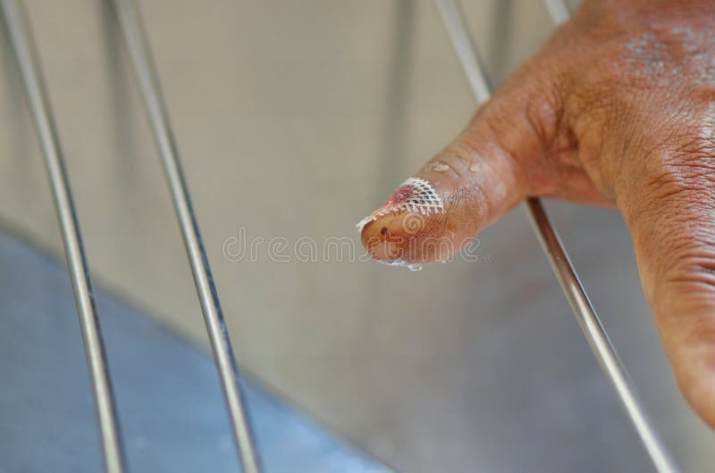 Blessure de coupe de pouce photo stock. Image du pouce - 57954646