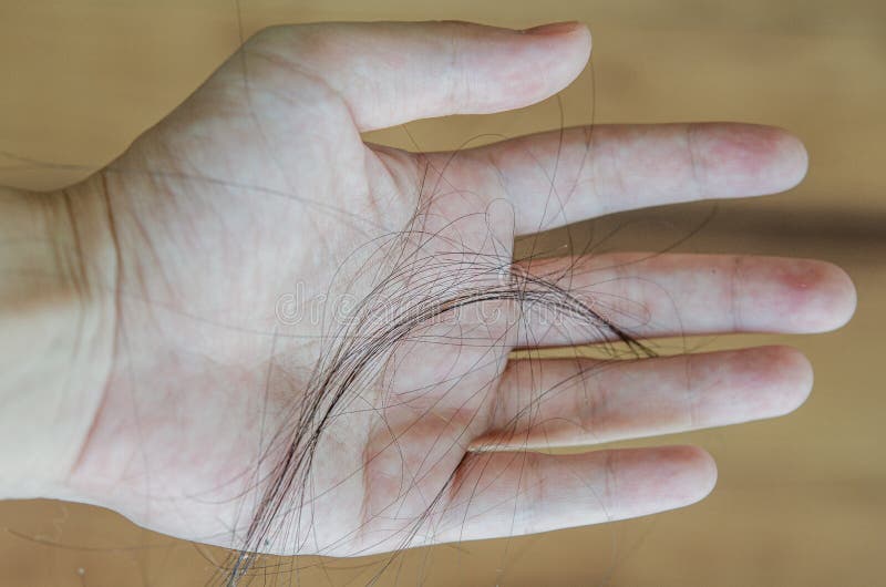 Hair falling on hand stock photo. Image of dandruff - 182133166