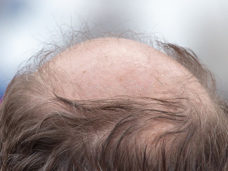 The Hair Falls Out on the Head of a Man. Stock Photo - Image of ...