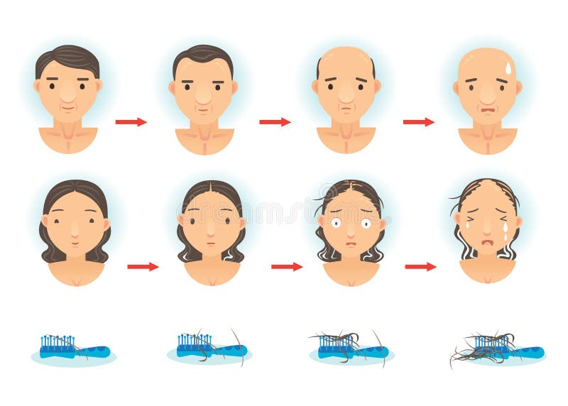 Hair Loss Stock Illustrations – 10,659 Hair Loss Stock Illustrations ...