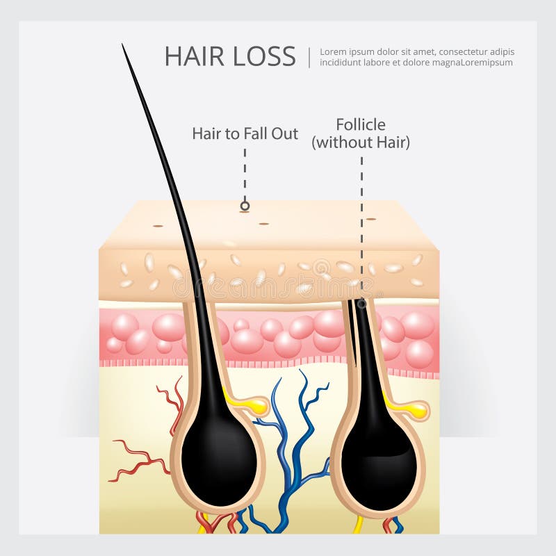 Hair Removal Example stock vector. Illustration of abscess - 178008309
