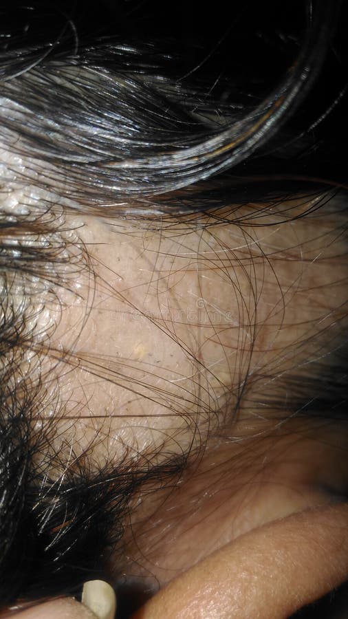 Hair patch,hair loss stock image. Image of patch, loss - 127504731