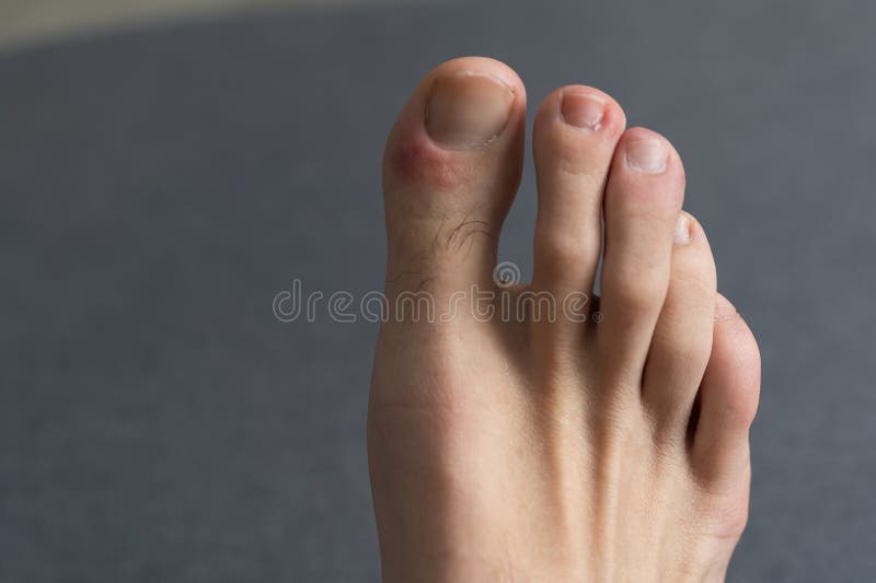 Hair and Pimples on Men& X27;s Toes Stock Photo - Image of lymphatic ...