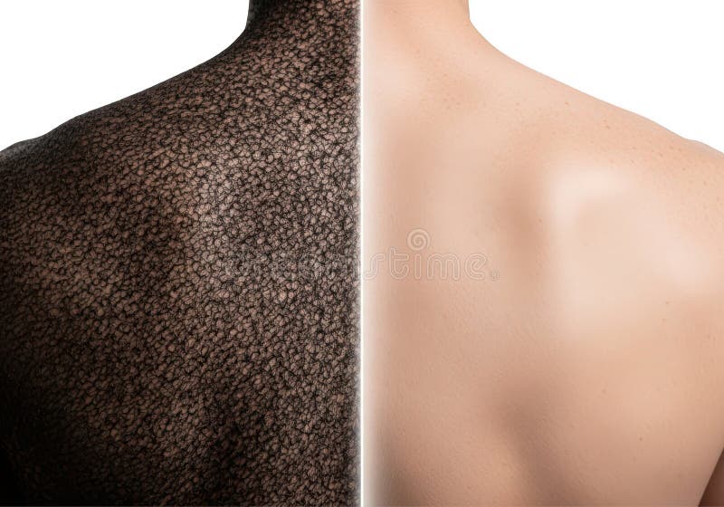 Before and after Hair Removal Comparison Showing Smooth Skin Versus ...