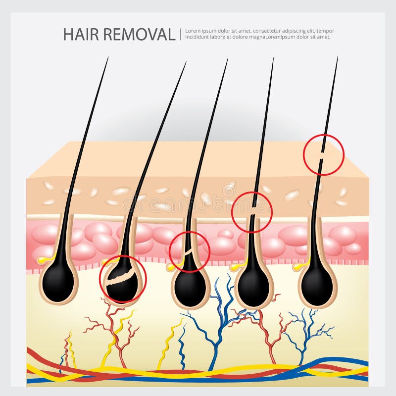 Human Ingrown Hair Structure Stock Vector - Illustration of layer ...