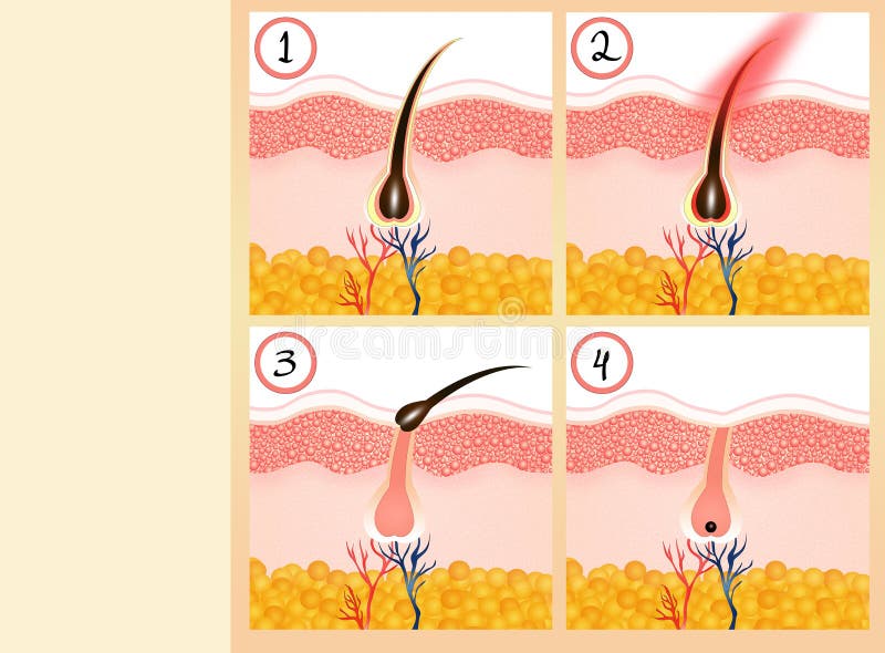 Root Removal Stock Illustrations – 2,116 Root Removal Stock ...