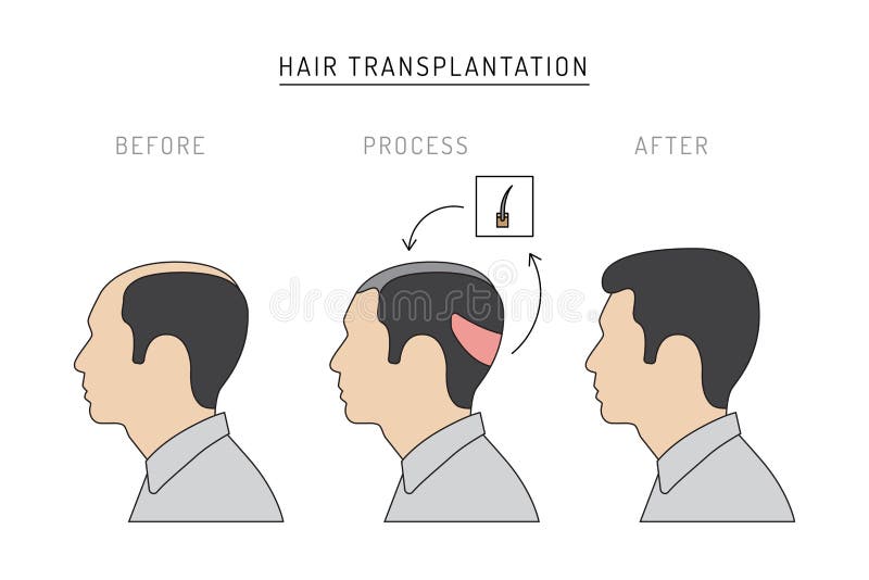 Alopecia Stages Set Hair Loss Balding Process Stock Vector