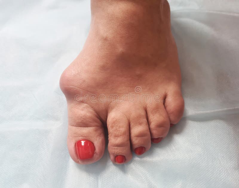 Valgus Deformity of Foot and Fixator for Treatment Closeup Stock Image ...