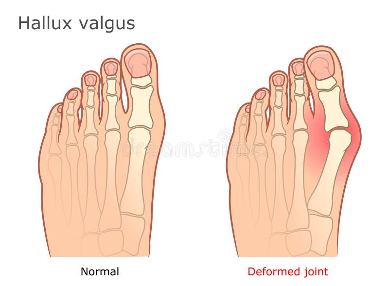 Hallux valgus illustration stock vector. Illustration of human - 193720399