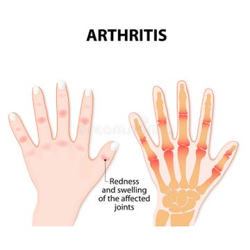 Hand Arthritis Stock Illustrations – 5,737 Hand Arthritis Stock ...