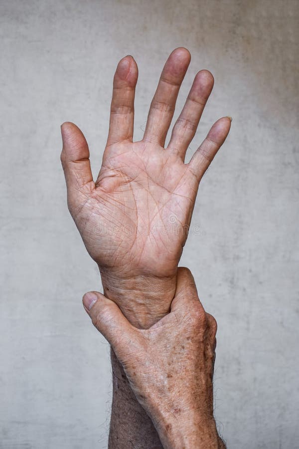Hand of Asian Elder Man. Concept of Joint Pain, Rheumatoid Arthritis or ...