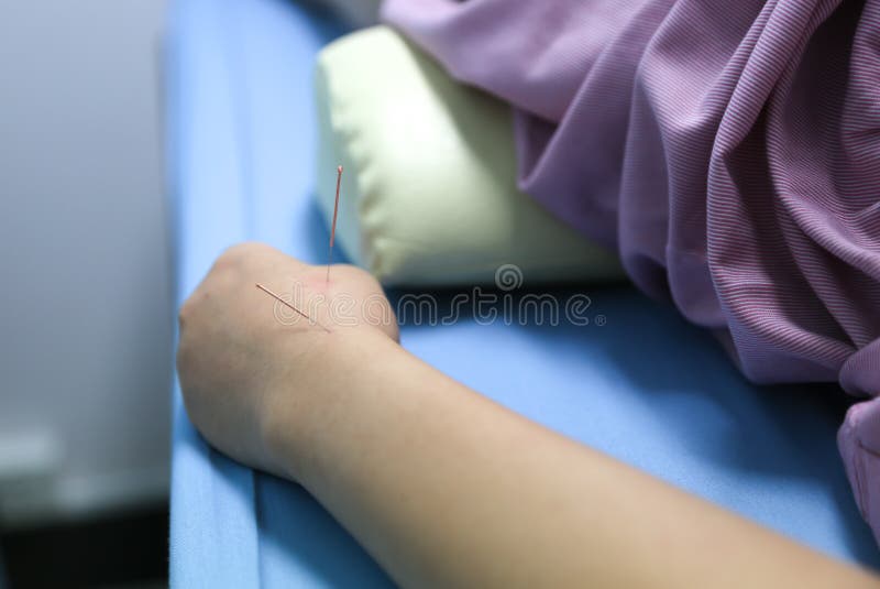 Hand of a Woman with Acupuncture Treatment Stock Image - Image of ...