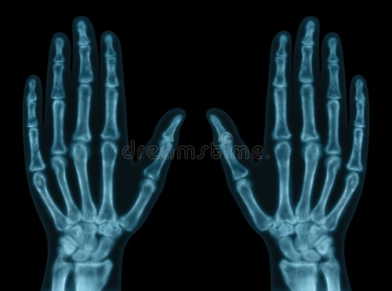 Hand Bones stock image. Image of analysis, human, joint - 17223575