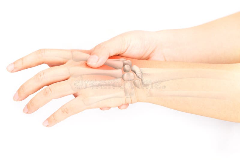 Hand bones injury stock photo. Image of ache, osteoarthritis - 76661374