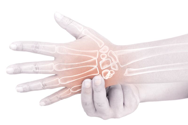 Hand bones injury stock photo. Image of numbness, brittle - 77609850