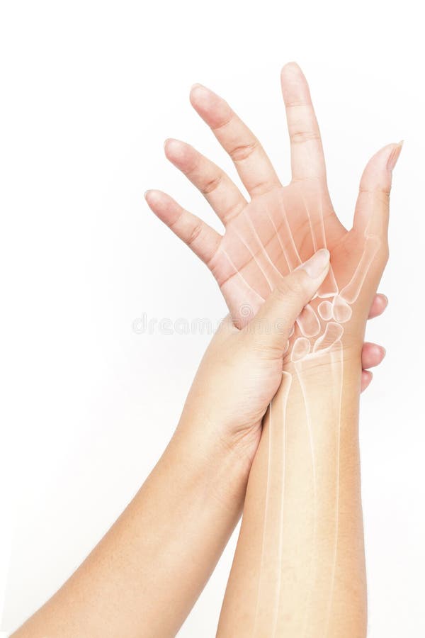 Hand bones injury stock image. Image of metacarpal, inflame - 149137547