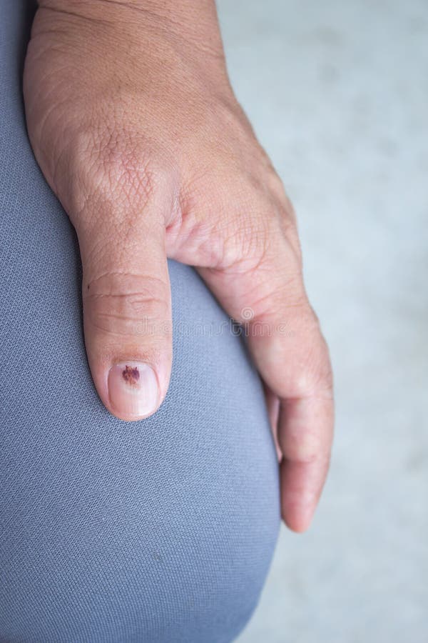 Bruised finger nail stock image. Image of thumb, white - 31347635