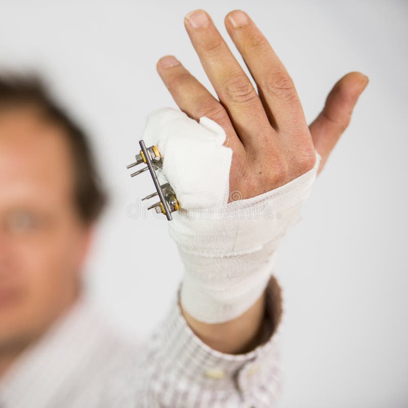 Hand with complex fracture stock photo. Image of corrected - 52044010
