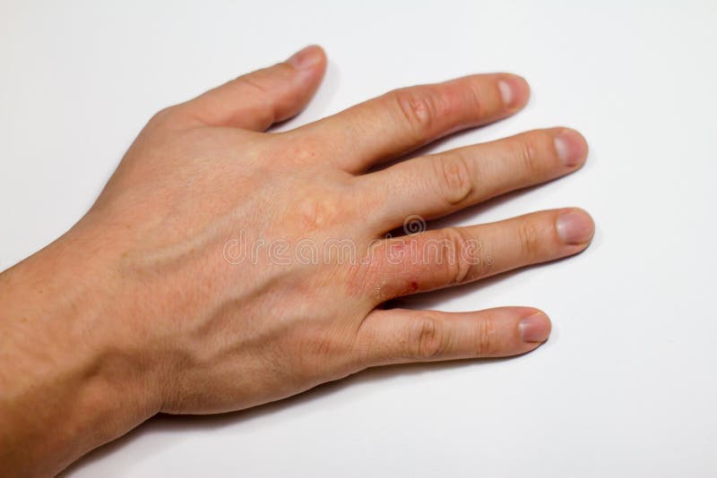 Dyshidrotic Eczema, Also Known As Pompholyx Or Cheiropompholyx, In The ...