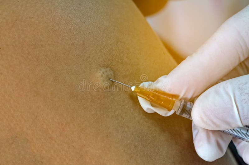 Hand of Doctor Inject Vaccine Solution in Intradermal Stock Photo ...