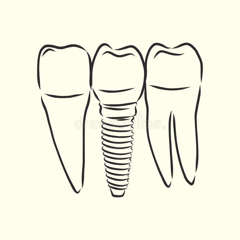 Molar Tooth Drawing