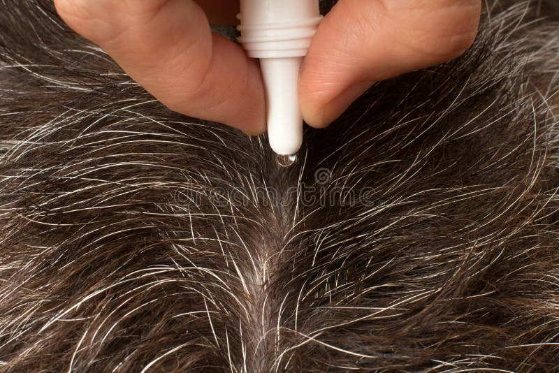 Bites from fleas stock photo. Image of dermatology, itchy - 98849006