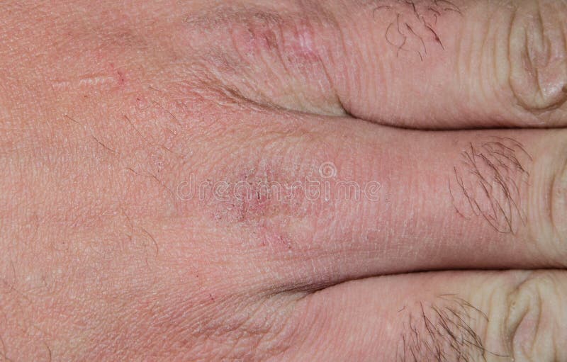 Hand Droge Gebarsten Huid in De Winter Stock Afbeelding - Image of ...