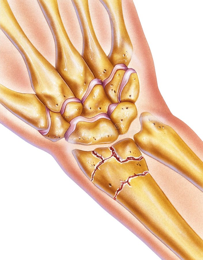 Hand en Gebroken Pols stock illustratie. Illustration of ...