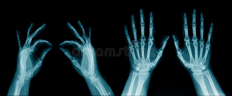 Hand and Finger X-ray Image Stock Image - Image of people, medical ...