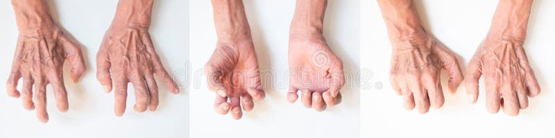 Hand and Finger Symptoms of the Elderly with Bone and Tendon Symptoms ...