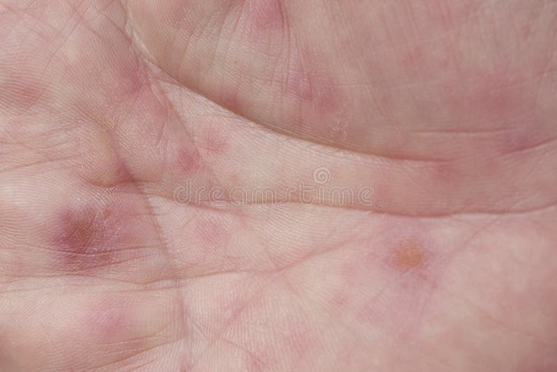 Hand, Foot and Mouth Disease Stock Image - Image of isolated, adult ...