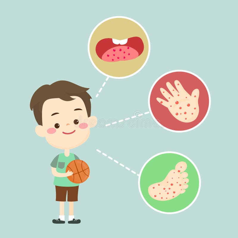 Hand Foot Mouth Disease Stock Illustrations – 130 Hand Foot Mouth ...