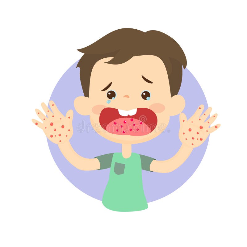 Mouth Ulcer Stock Illustrations – 581 Mouth Ulcer Stock Illustrations ...