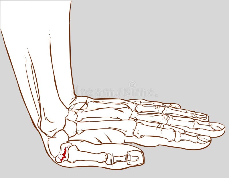 Stress Fracture Of Wrist Bone Icon . Vector Flat Design For Radiology ...