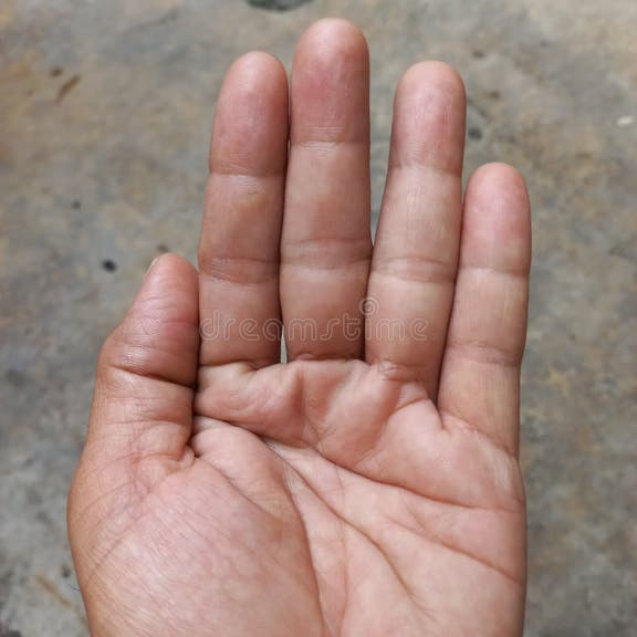 The Hand Has Two Definitions the Broad Definition is the Limb from the ...