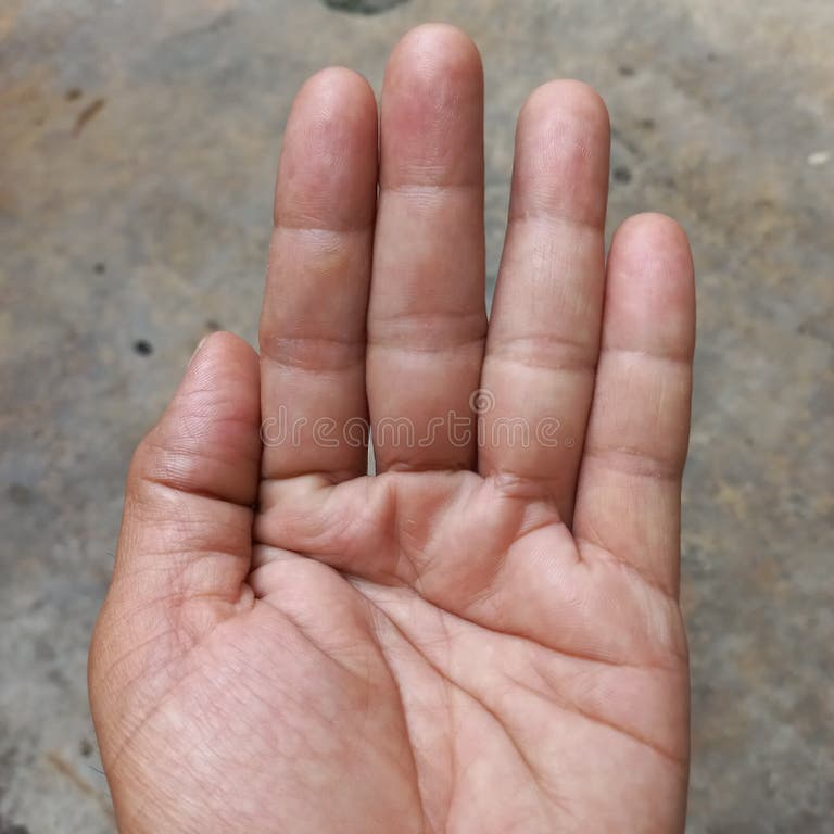 The Hand Has Two Definitions the Broad Definition is the Limb from the ...