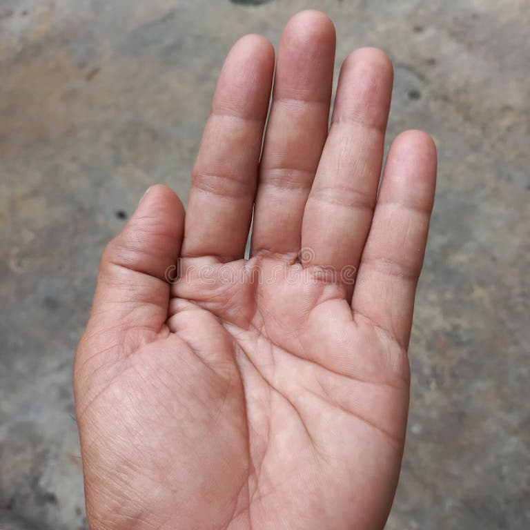 The Hand Has Two Definitions the Broad Definition is the Limb from the ...